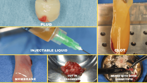Use of PRF in dentistry | Dental Iceberg