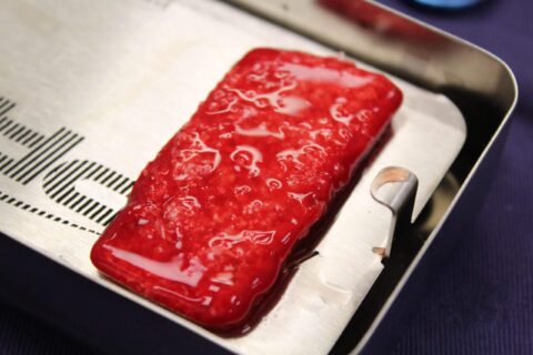 Sticky Bone Use in Implant Dentistry | Dental Iceberg