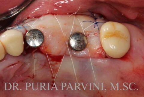 Soft Tissue Grafting Masterclass in London | Dental Iceberg