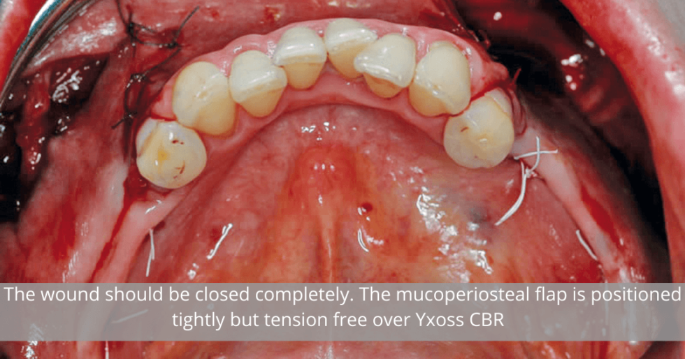 Yxoss mesh - Customised bone regeneration Course | Dental Iceberg