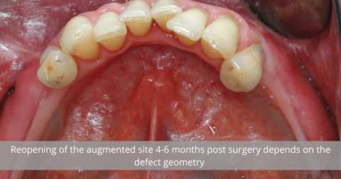 Yxoss mesh - Customised bone regeneration Course | Dental Iceberg