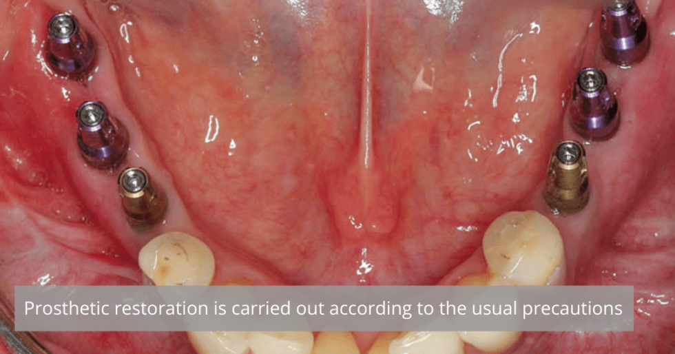 Yxoss mesh - Customised bone regeneration Course | Dental Iceberg