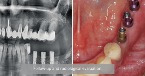 Yxoss mesh - Customised bone regeneration Course | Dental Iceberg