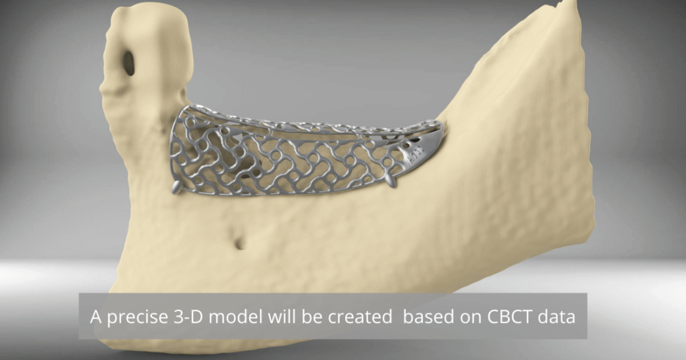 Yxoss mesh - Customised bone regeneration Course | Dental Iceberg