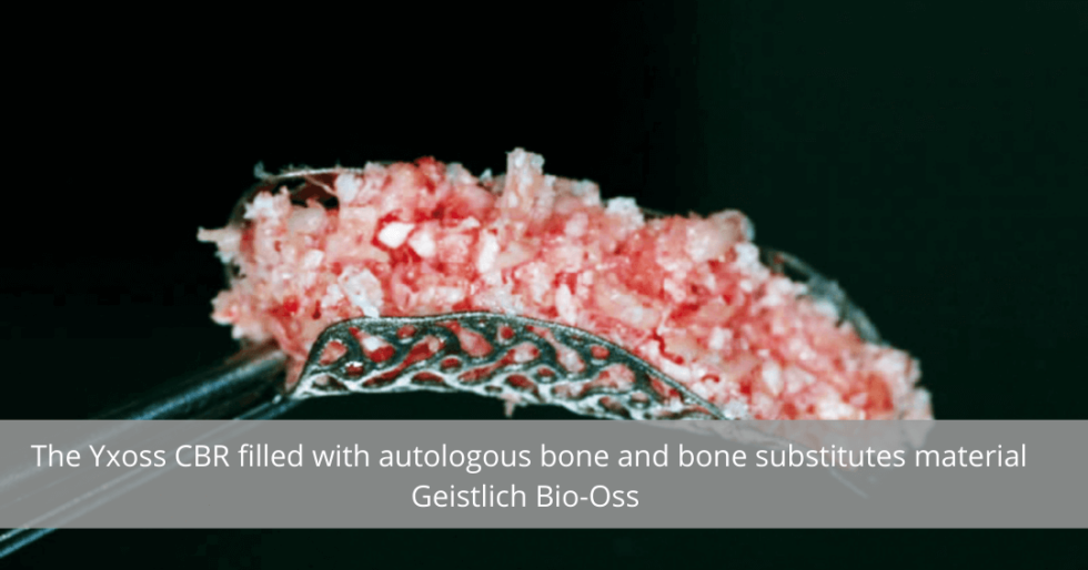 Yxoss mesh - Customised bone regeneration Course | Dental Iceberg