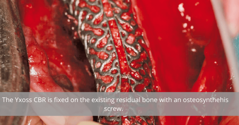 Yxoss mesh - Customised bone regeneration Course | Dental Iceberg